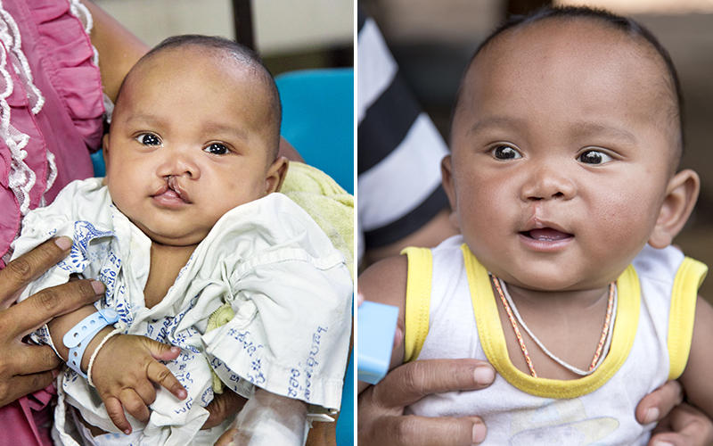 Kunanon ‘Oat’ Rinthang – Operation Smile Thailand